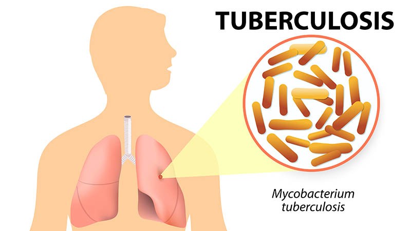 Tuberculosis, la enfermedad que puede causar daño permanente en los ...